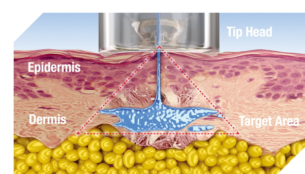 [KIMES 2015 Preview] UNION MEDICAL to Showcase New Skin Lifting ...