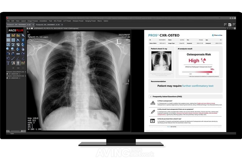 Promedius to unveil AI-based osteoporosis screening solution PROS® CXR ...