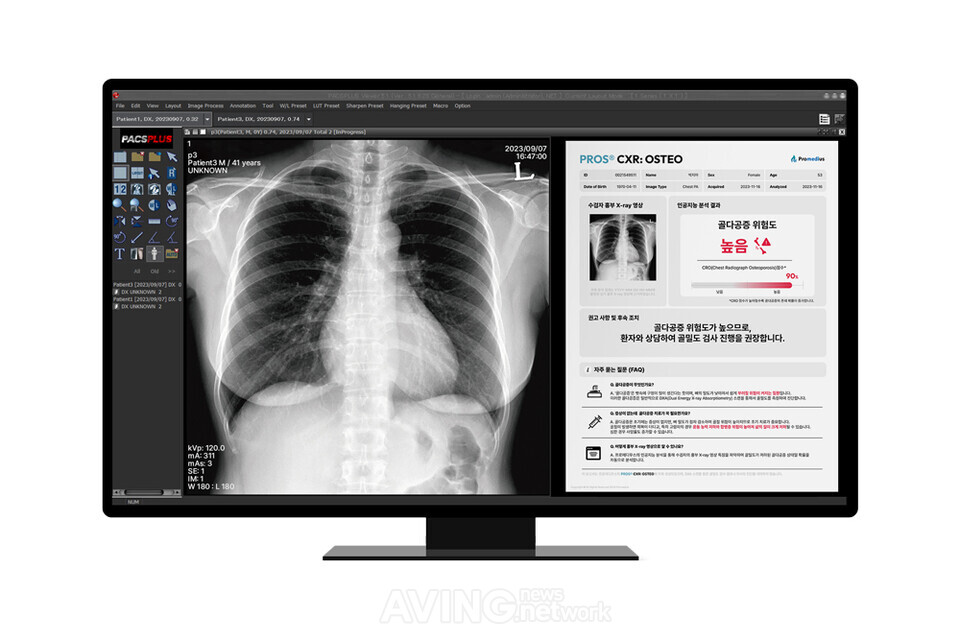 Promedius showcases early osteoporosis detection solution ‘PROS CXR: OSTEO’ at KIMES 2025 ...
